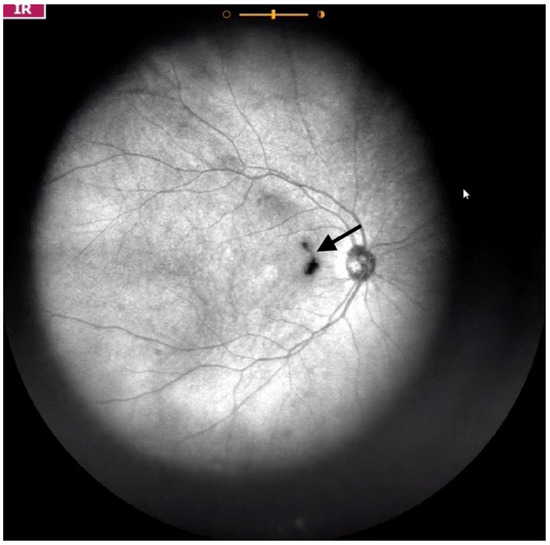 Visualization and Grading of Vitreous Floaters Using Dynamic Ultra ...