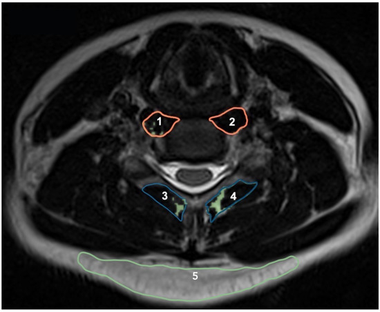 JCM | Free Full-Text | Fat Infiltration of Multifidus Muscle Is ...