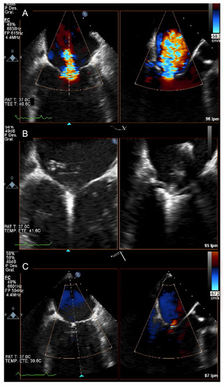Acute Ischaemic Mitral Valve Regurgitation