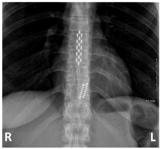 Combining Awake Anesthesia with Minimal Invasive Surgery Optimizes ...