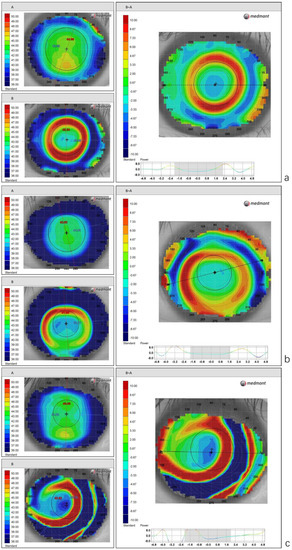 To Achieve a Bullseye: Factors Related to Corneal Refractive Therapy ...