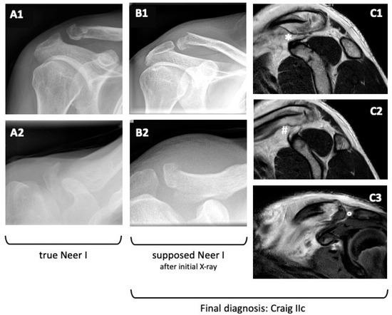 The Accuracy of Distal Clavicle Fracture Classifications—Do We Need an ...