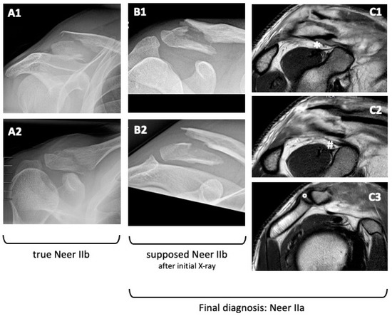 The Accuracy of Distal Clavicle Fracture Classifications—Do We Need an ...