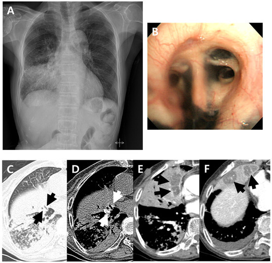 The Atypical Manifestation of Pulmonary Tuberculosis in Patients with ...