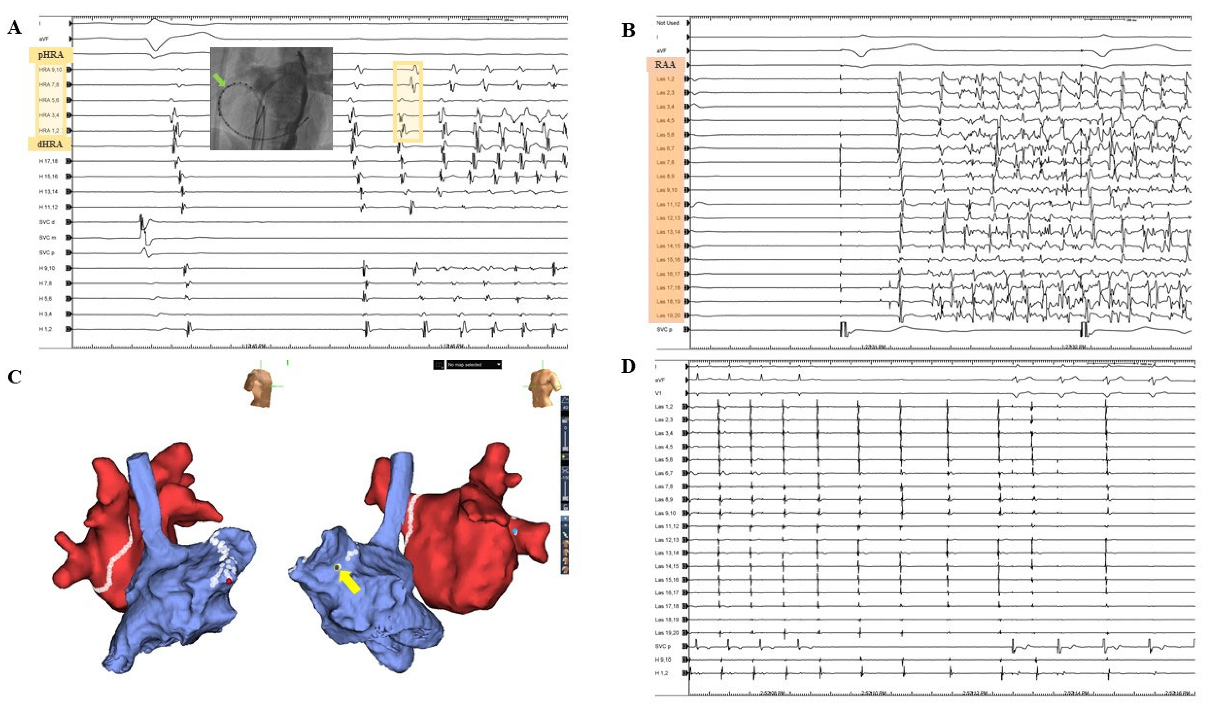 Clinical Significance of Adenosine-Induced Atrial Fibrillation after Complete Pulmonary Vein ...