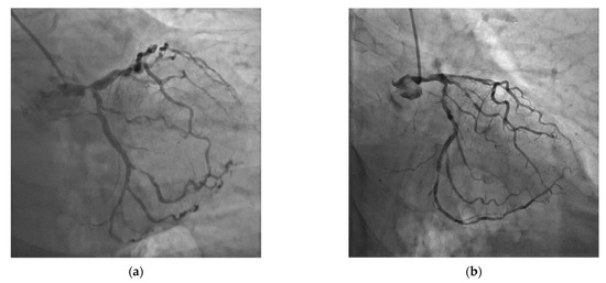 Left Main Coronary Artery Disease—Current Management and Future ...