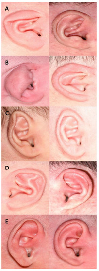 Efficacy of Classic Ear Molding for Neonatal Ear Deformity: Case Series ...