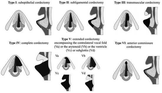 Laryngeal Cancer Surgery: History and Current Indications of Transoral ...