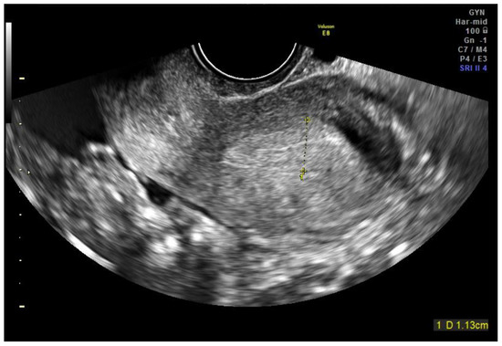 Is It Possible to Diagnose Preoperatively a Tubal Ectopic Hydatidiform ...