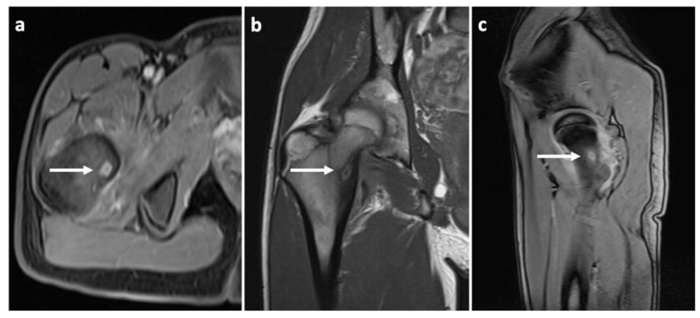 Current Approaches to Osteoid Osteoma and Minimally Invasive Surgery—A ...