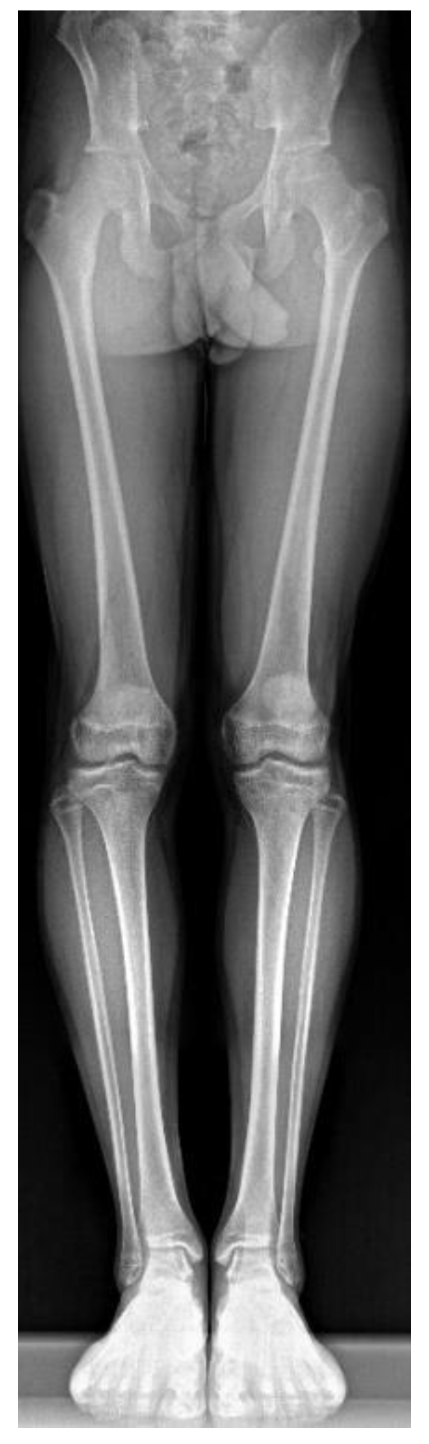 Current Approaches to Osteoid Osteoma and Minimally Invasive Surgery—A ...