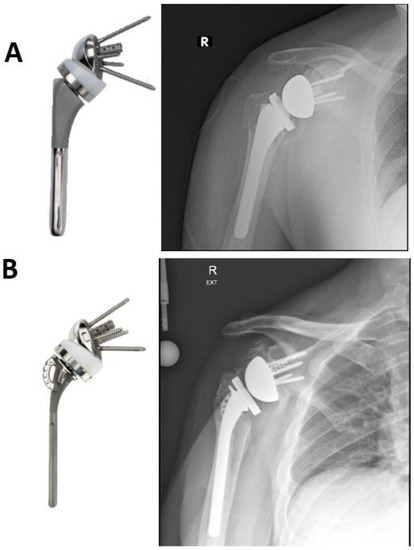 The Evolution of Reverse Total Shoulder Arthroplasty and Its Current ...