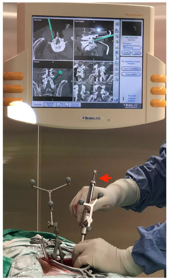High Accuracy and Safety of Intraoperative CT-Guided Navigation for Transpedicular Screw ...