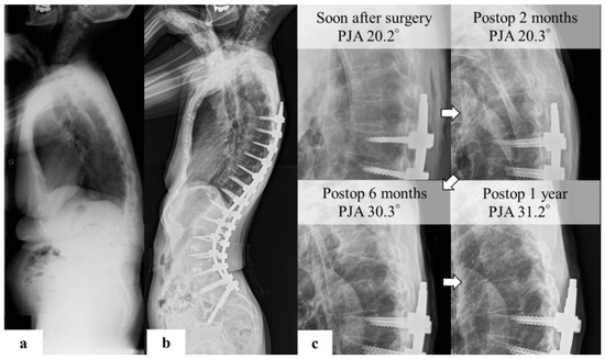 Can Proximal Junctional Kyphosis after Surgery for Adult Spinal ...