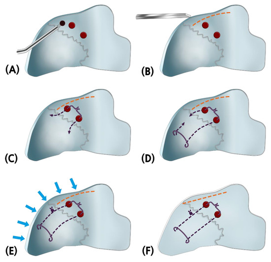 Internal Nasal Valve Modification via Correction of High Dorsal ...