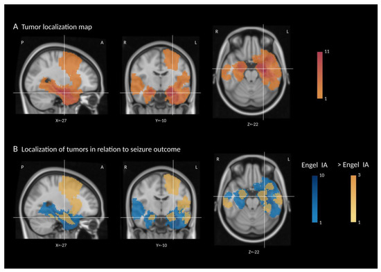 Early Epilepsy Surgery in Benign Cerebral Tumors: Avoid Your ‘Low-Grade ...