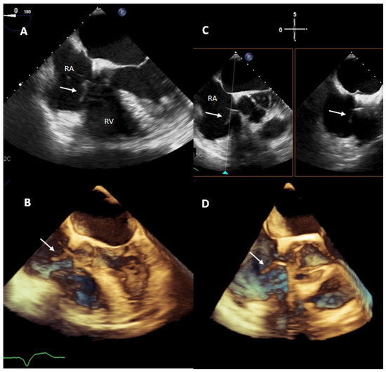Cardiac Implantable Electronic Devices Infection Assessment, Diagnosis ...