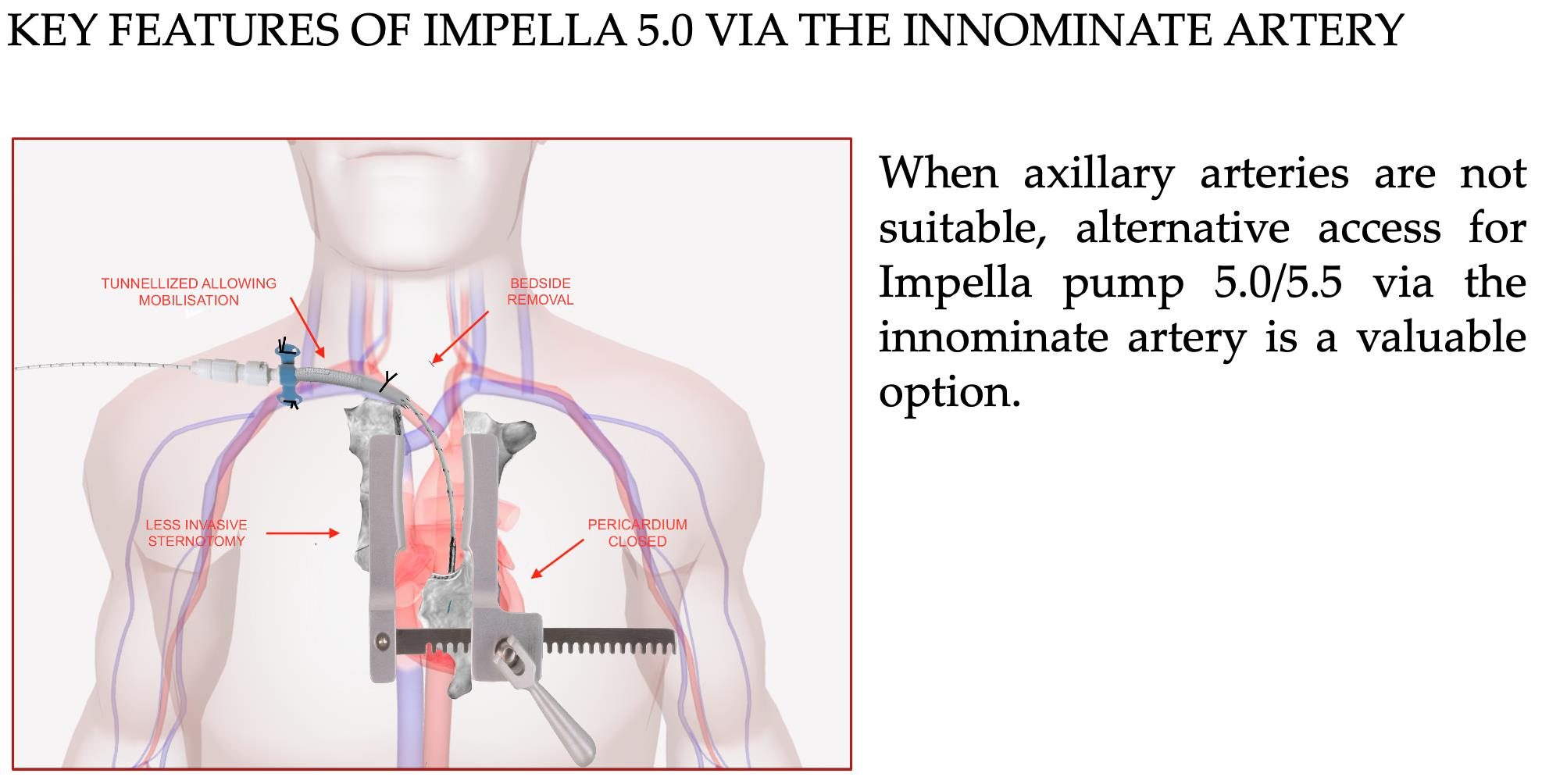 JCM | Free Full-Text | Impella 5.0/5.5 Implantation via Innominate Artery: Further Expanding the ...