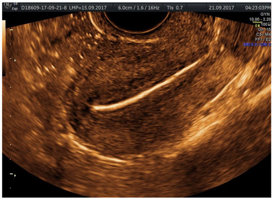Technical Tips and Tricks after 10 Years of HyFoSy for Tubal Patency ...