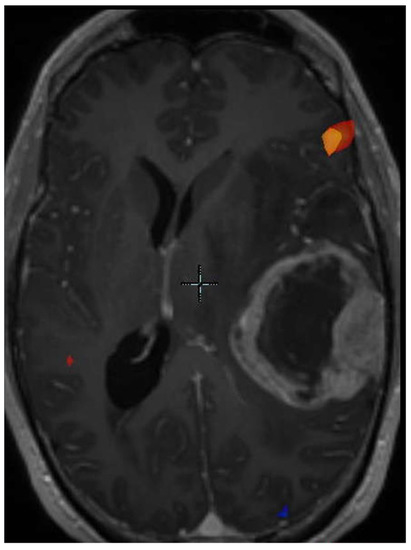 Imaging of GBM in the Age of Molecular Markers and MRI Guided Adaptive ...