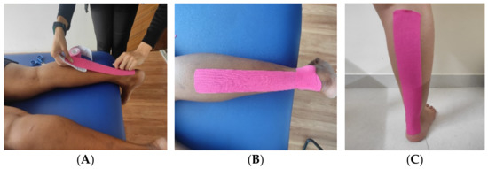 The Time-Based Effects of Kinesio Taping on Acute-Onset Muscle Soreness ...