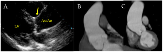JCM | Free Full-Text | Patients with Bicuspid Aortopathy and Aortic ...