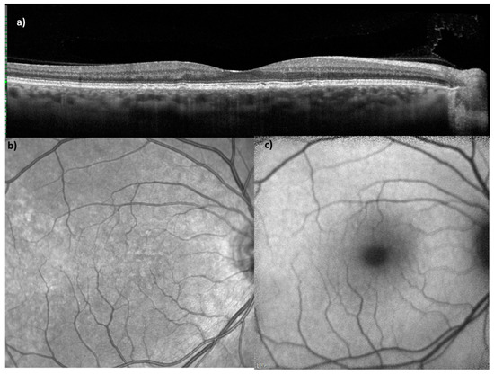 Structural Features of Patients with Drusen-like Deposits and Systemic ...