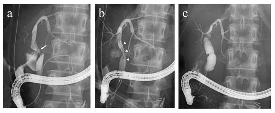 Endoscopic Bridge-and-Seal of Bile Leaks Using a Fully Covered Self ...