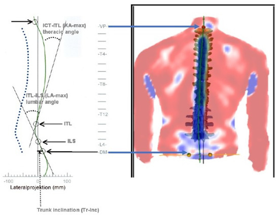Reduction of Thoracic Hyper-Kyphosis Improves Short and Long Term ...