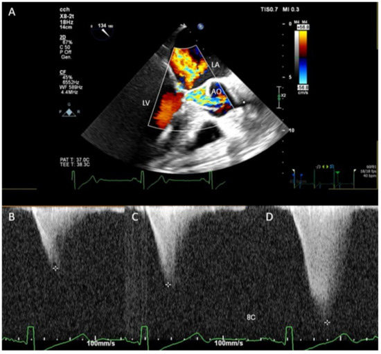 Mitral Valve Systolic Anterior Motion in Robotic Thoracic Surgery as ...