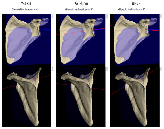 Glenoid Inclination: Choosing the Transverse Axis Is Critical—A 3D ...