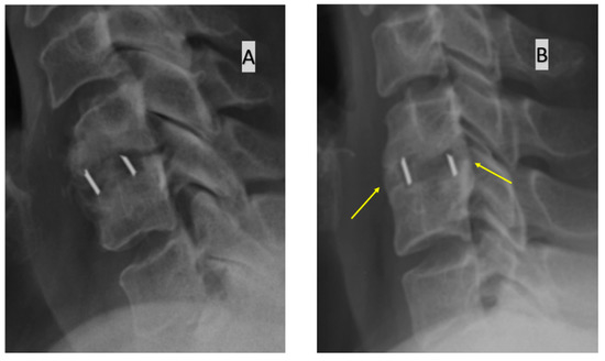 Reliability and Utility of Various Methods for Evaluation of Bone Union ...