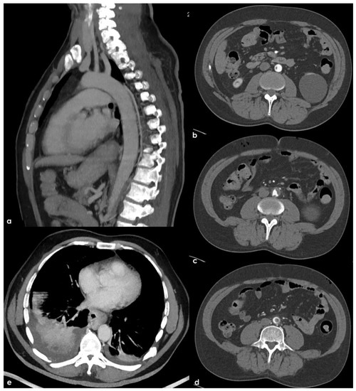 Neurovascular Manifestations of Iron-Deficient Anemia: Narrative Review ...
