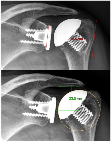 Clinical and Radiologic Outcomes after Anatomical Total Shoulder ...