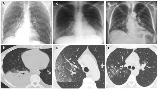 Legionella pneumophila: The Journey from the Environment to the Blood