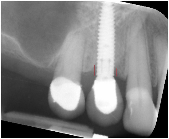 Are Torque-Induced Bone Texture Alterations Related to Early Marginal ...