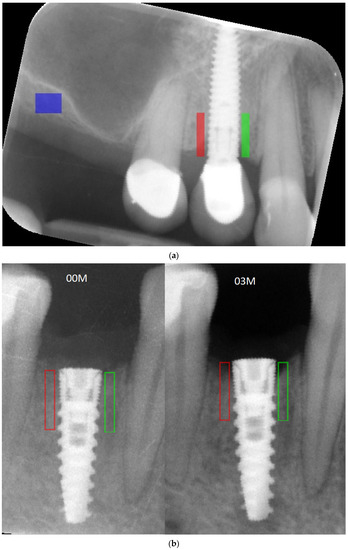 Are Torque-Induced Bone Texture Alterations Related to Early Marginal ...