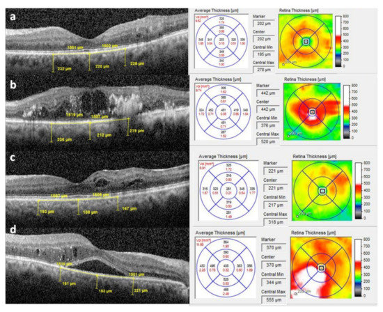 Choroidal Thickness in Different Patterns of Diabetic Macular Edema