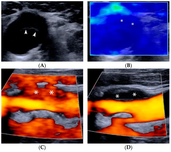 Advances in Noninvasive Carotid Wall Imaging with Ultrasound: A ...