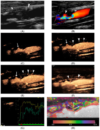 Advances in Noninvasive Carotid Wall Imaging with Ultrasound: A ...