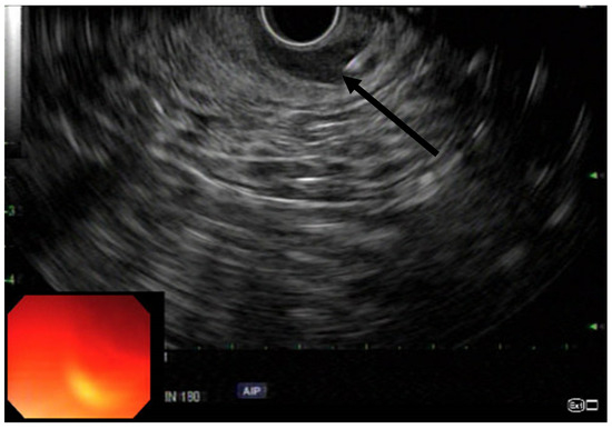 Endoscopic Ultrasound-Guided Botox Injection for Refractory Anal Fissure