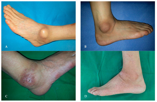 Characteristics of Synovial Fistula of the Ankle Joint: A Case Series