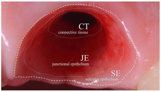 Association between Peri-Implant Soft Tissue Health and Different ...