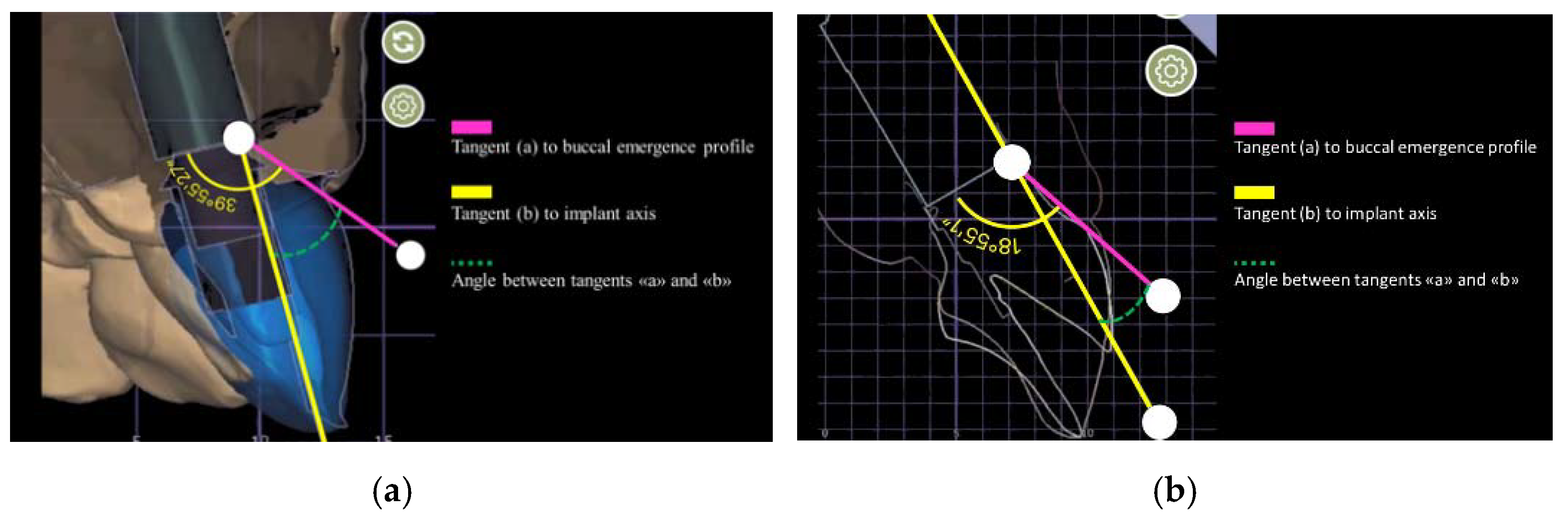 Association between Peri-Implant Soft Tissue Health and Different Prosthetic Emergence Angles in ...