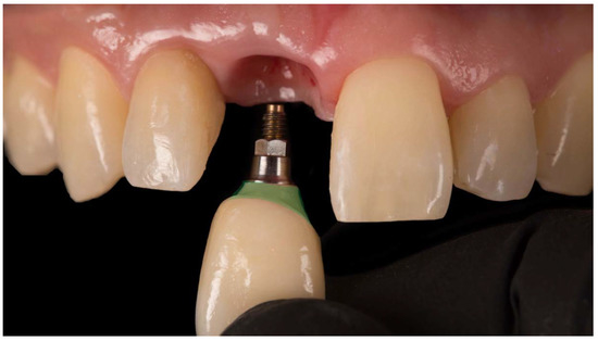 Association between Peri-Implant Soft Tissue Health and Different ...