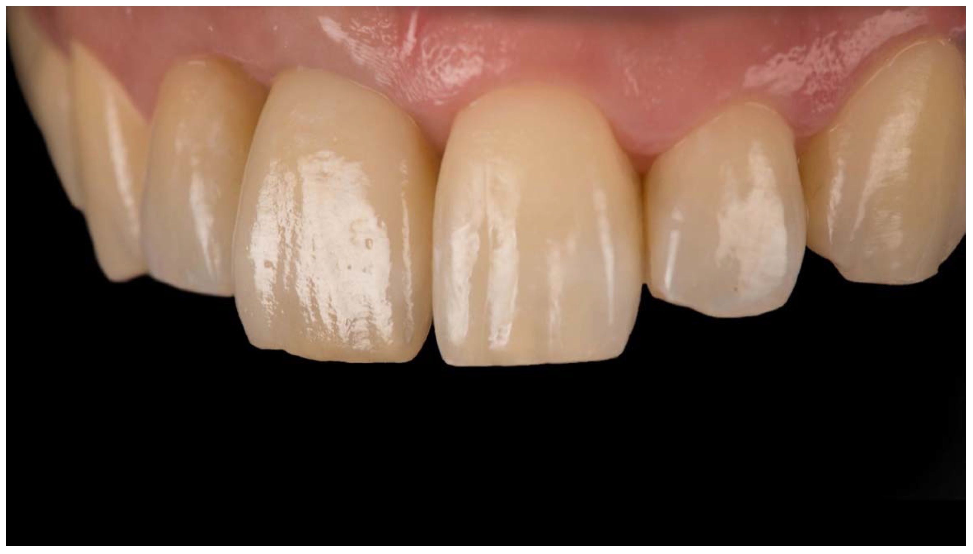 Association between Peri-Implant Soft Tissue Health and Different ...