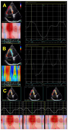 Right Ventricle in Arterial Hypertension: Did We Forget Something?