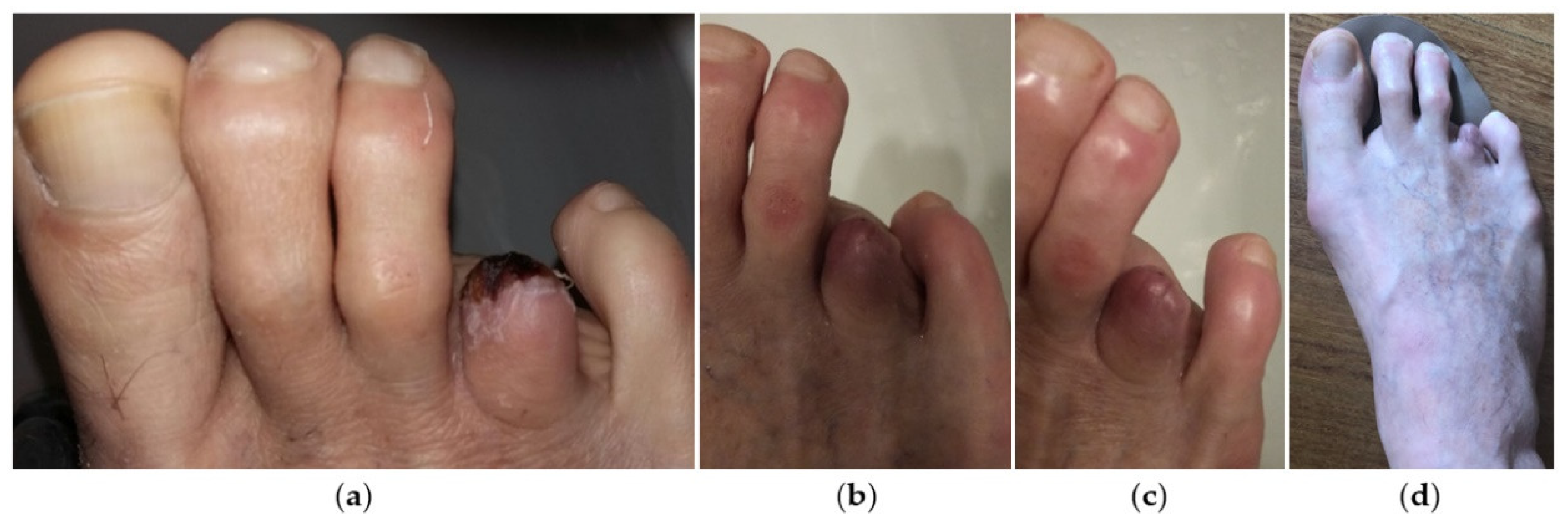 Alcohol Injections For Neuroma On The Foot Deals | emergencydentistry.com Alcohol Injections For Neuroma On The Foot Deals | emergencydentistry.com