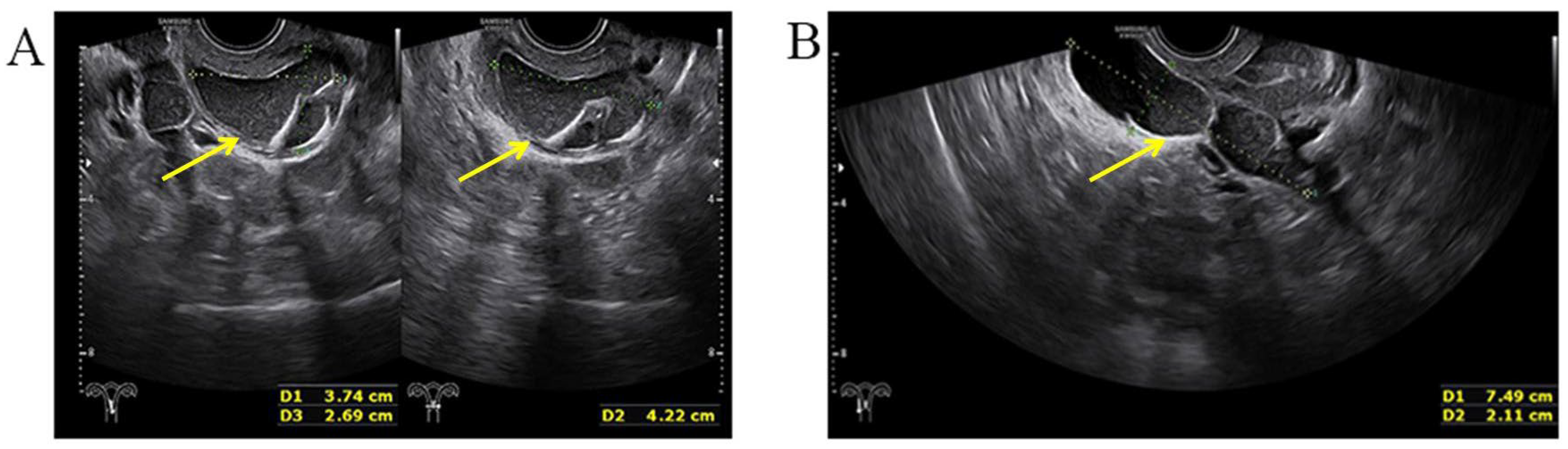 Gynecological Diagnosis and Treatment of Ectopic Ureter Insertion into Vagina: Analysis of Five ...