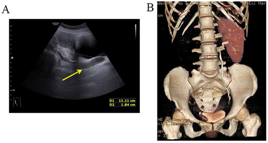 Gynecological Diagnosis and Treatment of Ectopic Ureter Insertion into ...